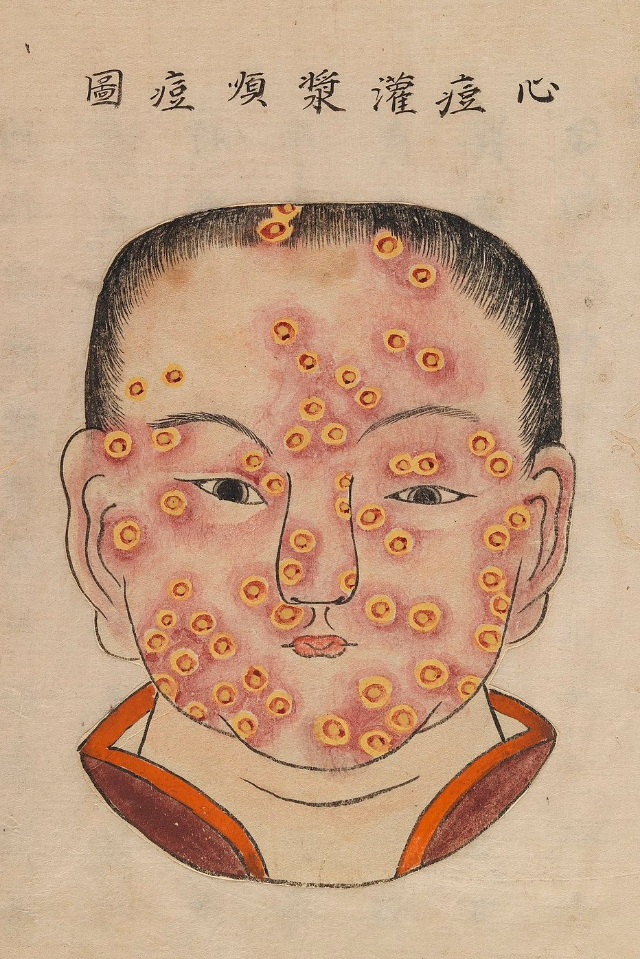 Smallpox Illustration, Japanese Manuscript, ca. 1720 | Vintage News Daily